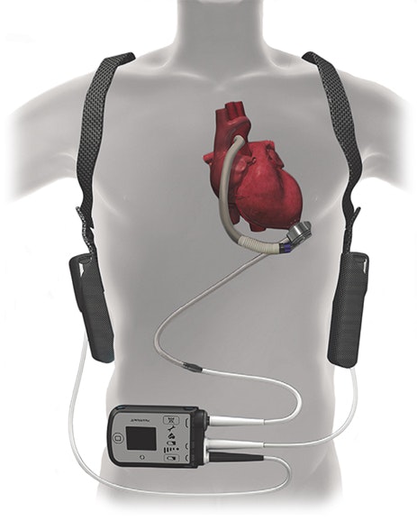 HeartMate 3 | YourStack